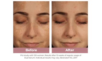 Eucerin Thiamidol For Hyperpigmentation: Complete Guide